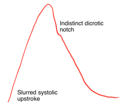 Diagnostics and Therapeutics: Arterial Lines and Invasive Blood Pressure Monitoring — Taming the SRU